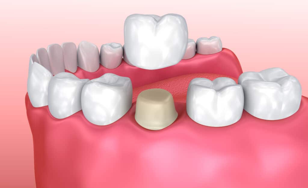 Dental Crowns Brisbane | Crowns and Bridges Open 7 Days